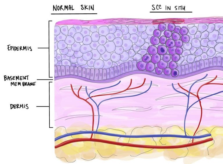Everyone gets cancer, some forms are less worrisome than others